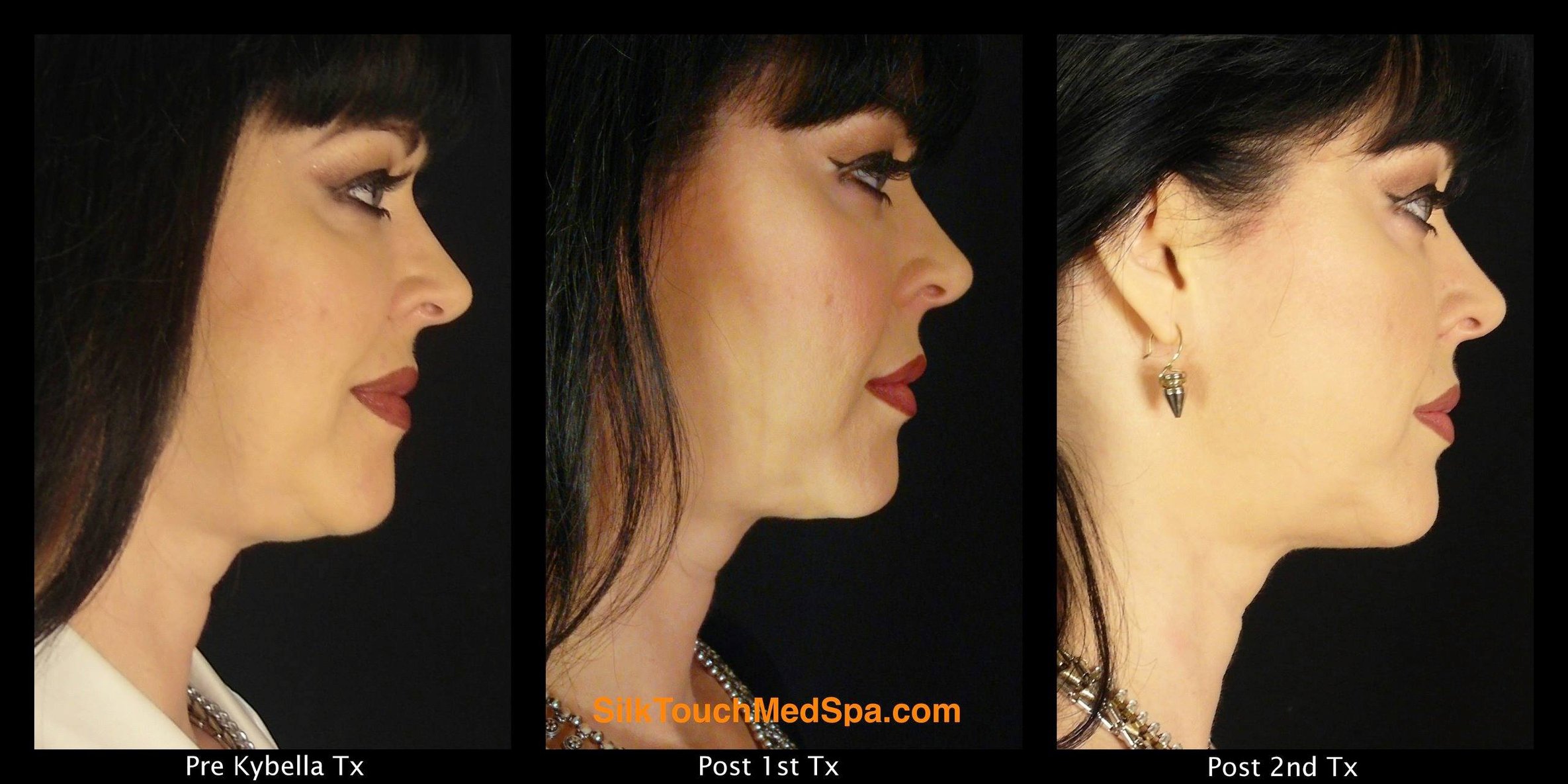 How To Tell If You Are A Kybella Candidate