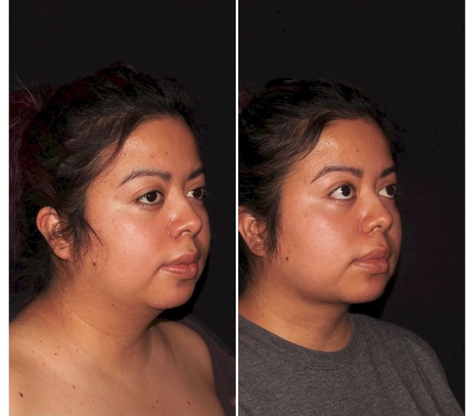 Neck Liposuction Roundup