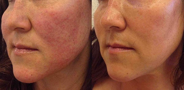 What is Rosacea?