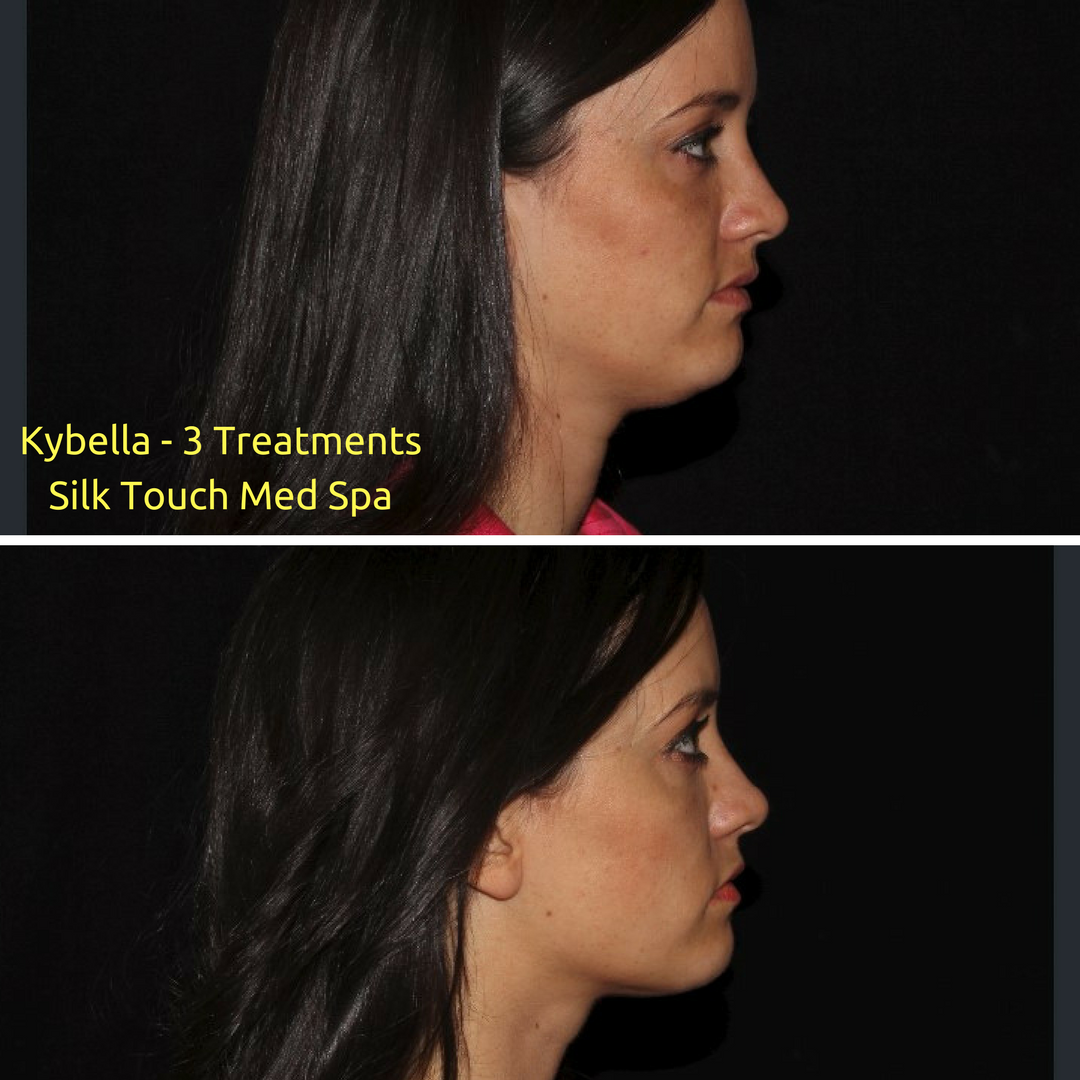 How To Tell If You Are A Kybella Candidate